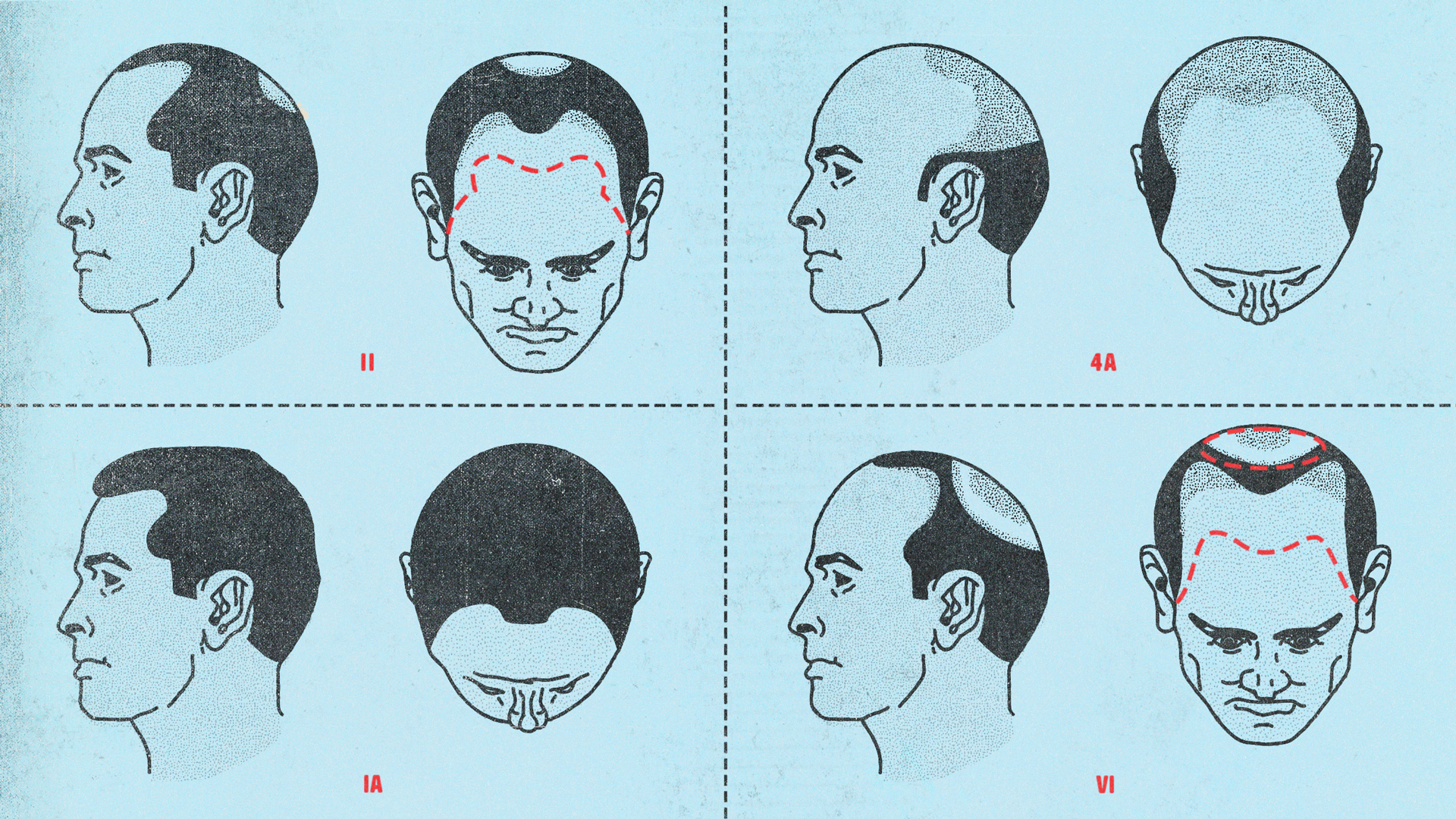 Why Do People Go To Turkey For Hair Transplants